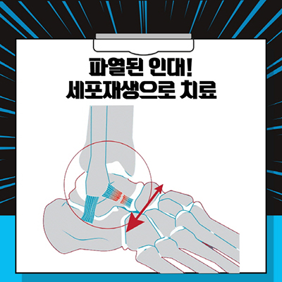 발목인대파열, 인대세포재생 치료로 긴 회복 기간 없이 빠른 회복 도움 - 스타데일리뉴스